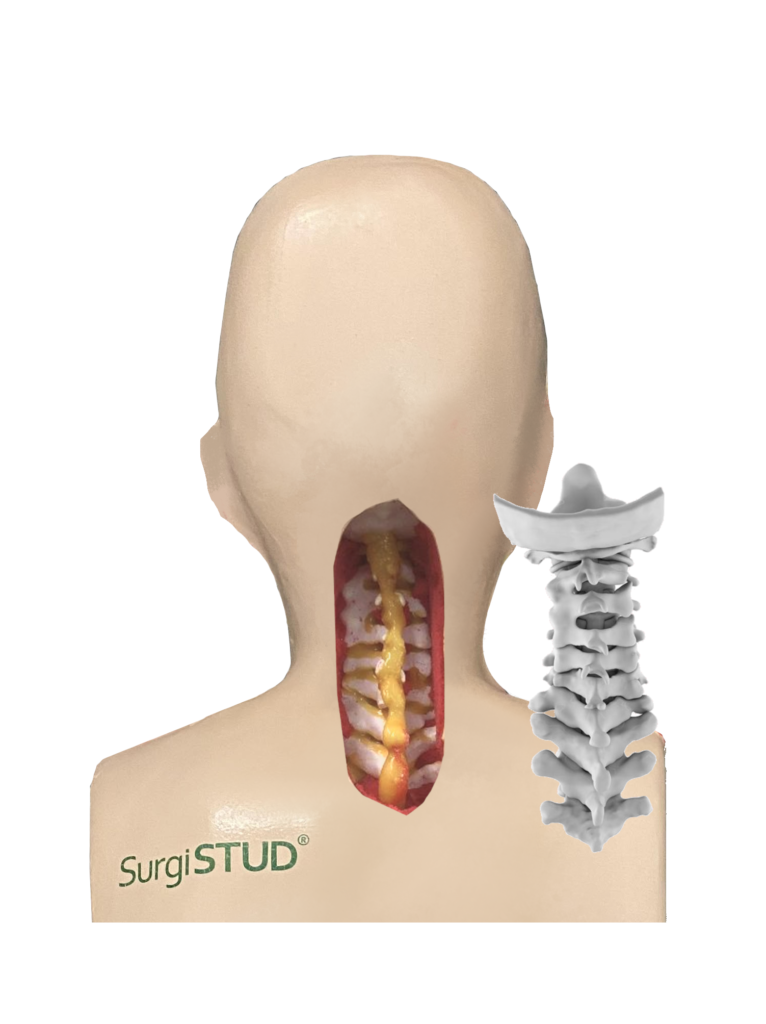 Chin-On-Chest Deformity 1 – SurgiSTUD