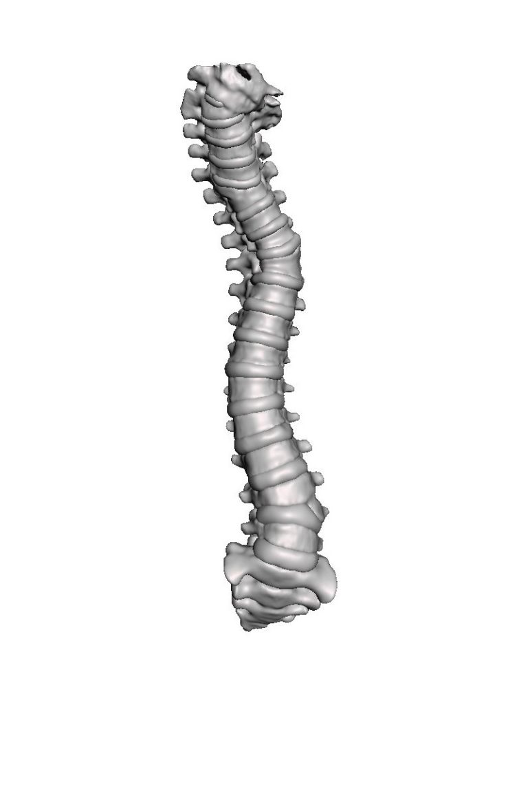Cervical, Thoracic & Lumbar Hemivertebrae – SurgiSTUD