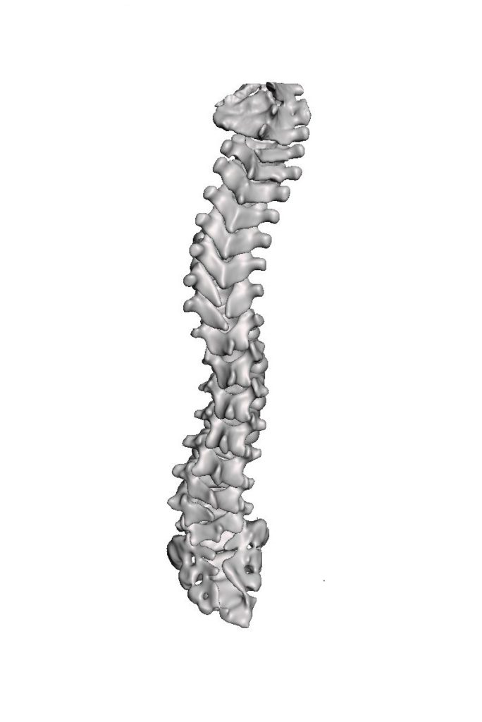 Cervical, Thoracic & Lumbar Hemivertebrae – SurgiSTUD