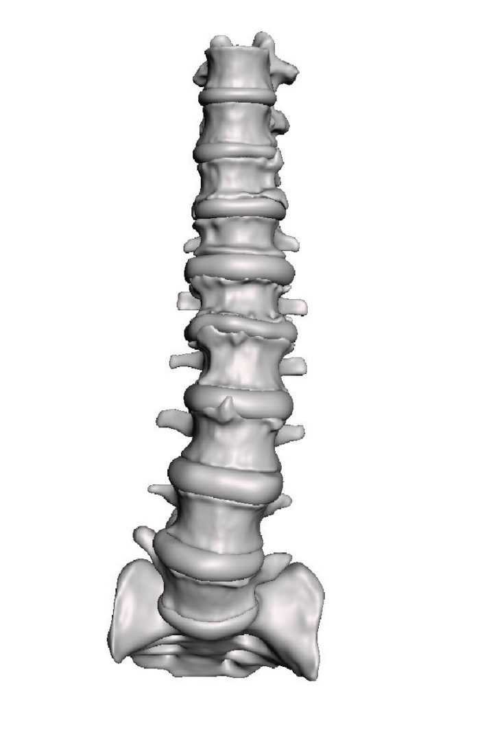 Moderate Thoracolumbar Spondylosis & Osteophytic Spurring – SurgiSTUD