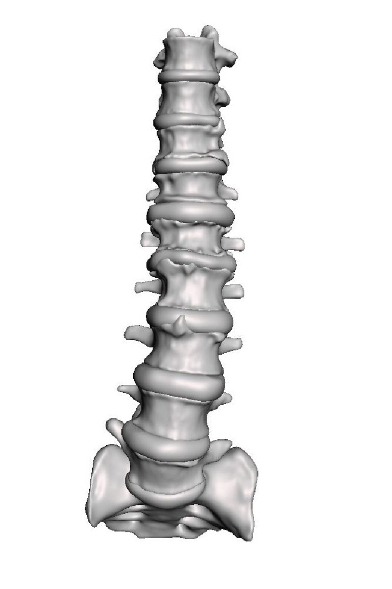 Moderate Thoracolumbar Spondylosis & Osteophytic Spurring – SurgiSTUD