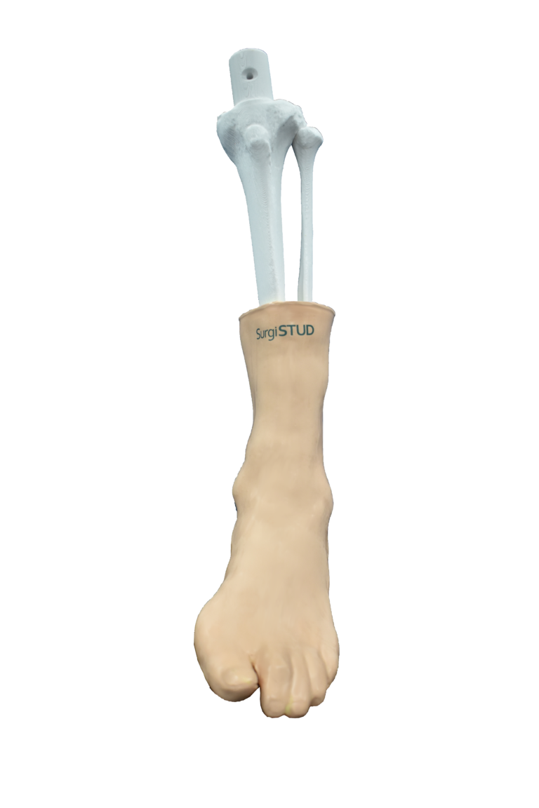 Weber B Fracture – SurgiSTUD