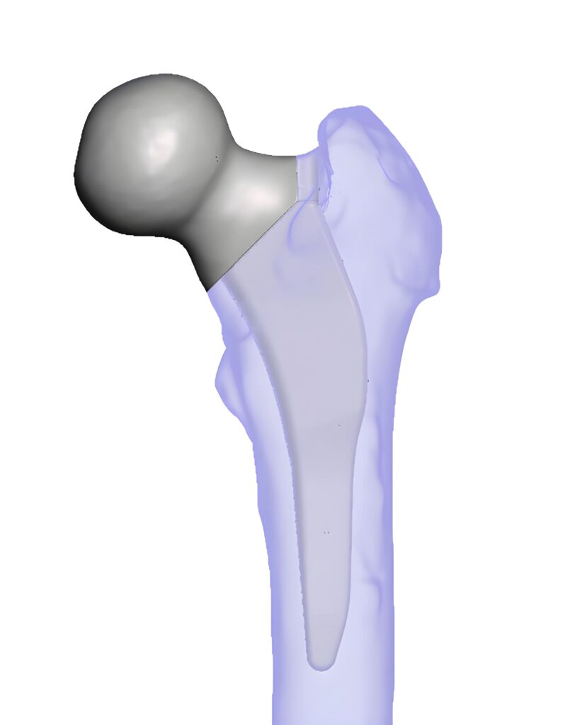 Pre-Broached Femur with Removable Head – SurgiSTUD